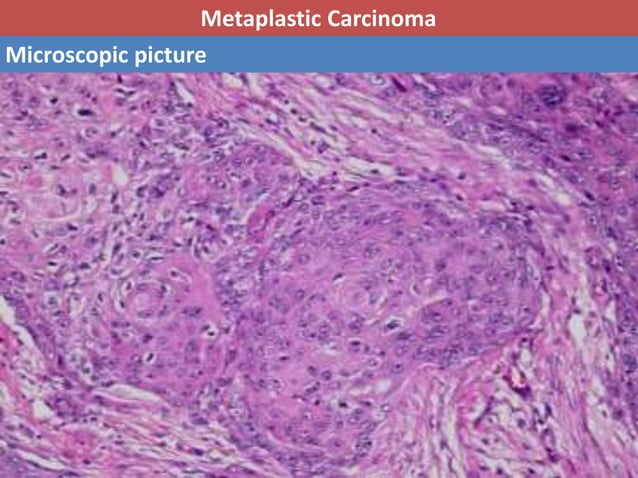 Pathology of breast cancer | PPTX