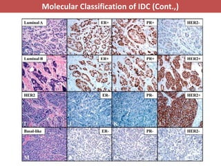 Pathology of breast cancer | PPTX
