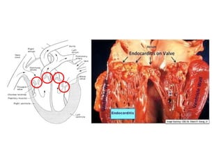 Pathology of cardiovascular system | PDF