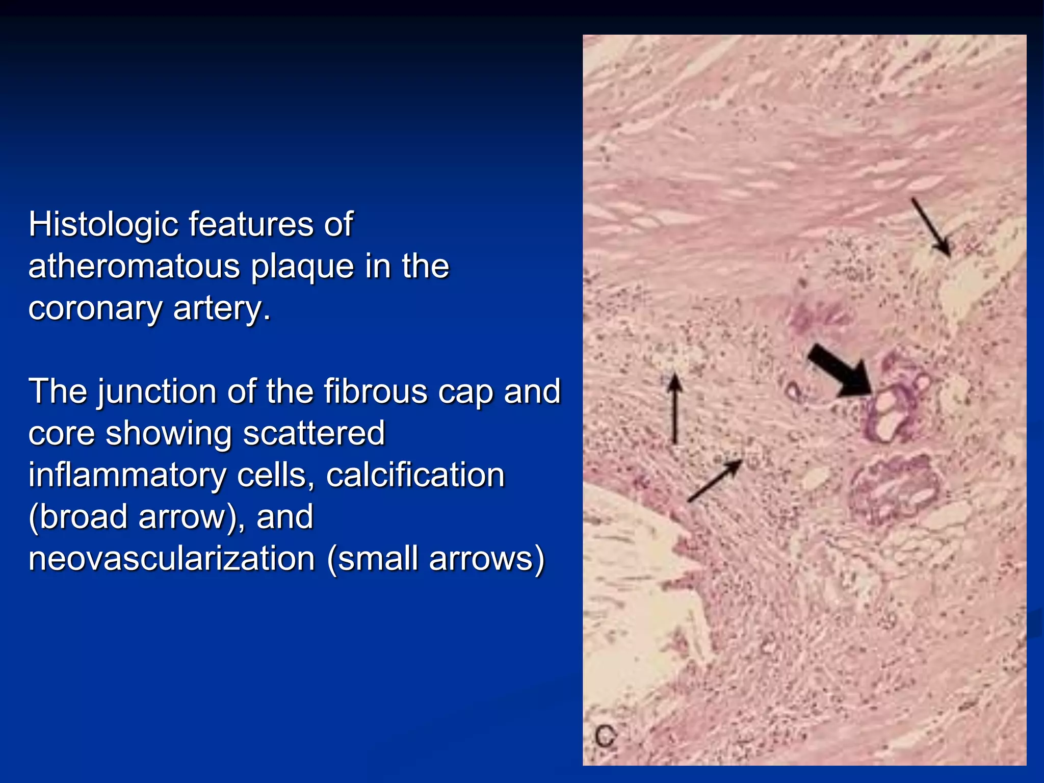 Pathology of cardiovascular system | PPT | Heart and Cardiovascular ...