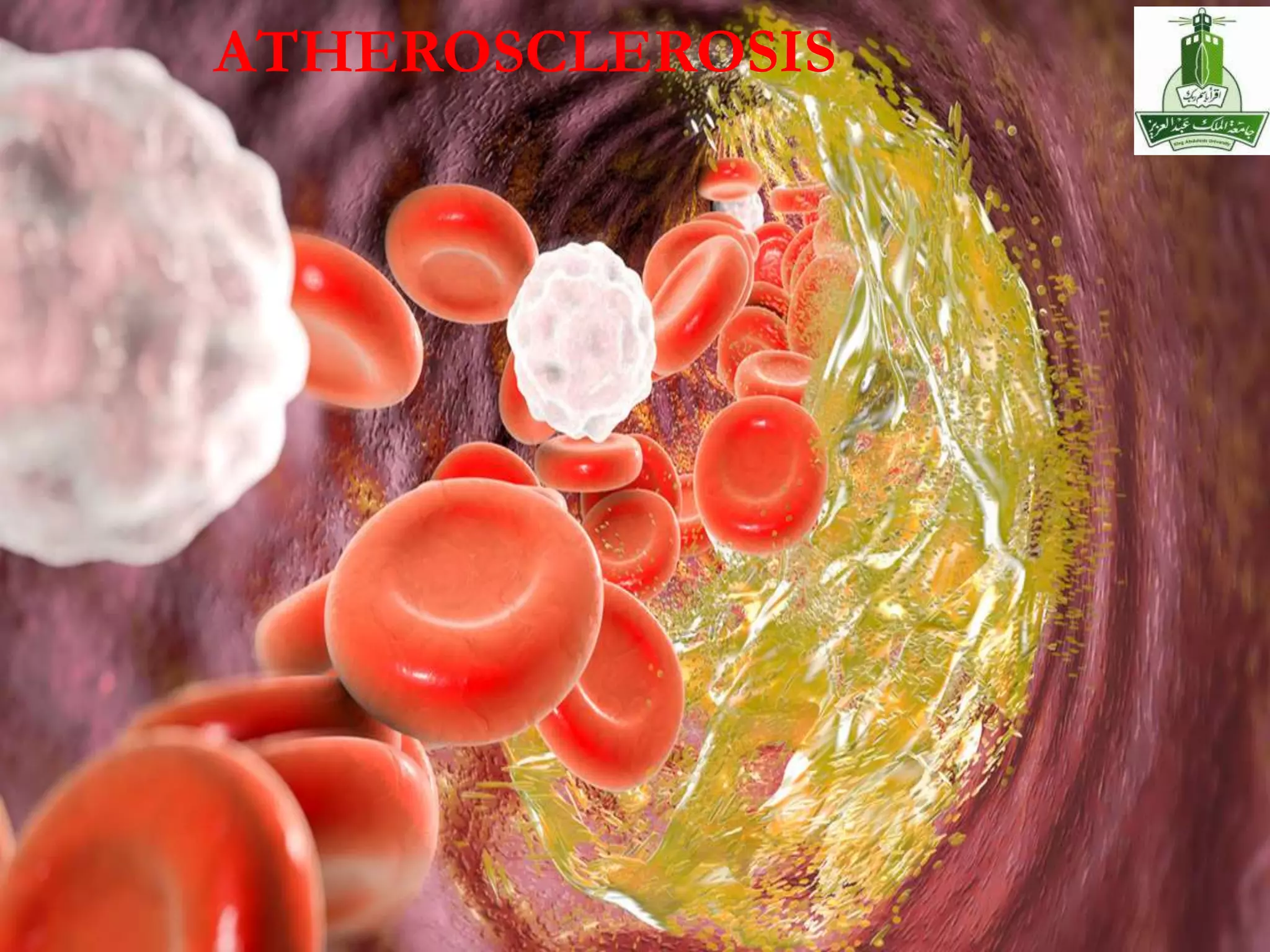 Pathology of cardiovascular system | PPT | Heart and Cardiovascular ...