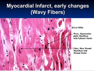 Pathology of cardiovascular system | PPT