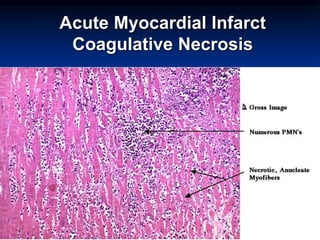 Pathology of cardiovascular system | PPT
