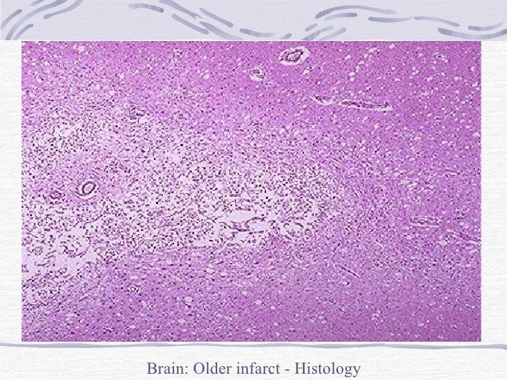 Pathology+of+cerebrovascular+disease+dr+anim