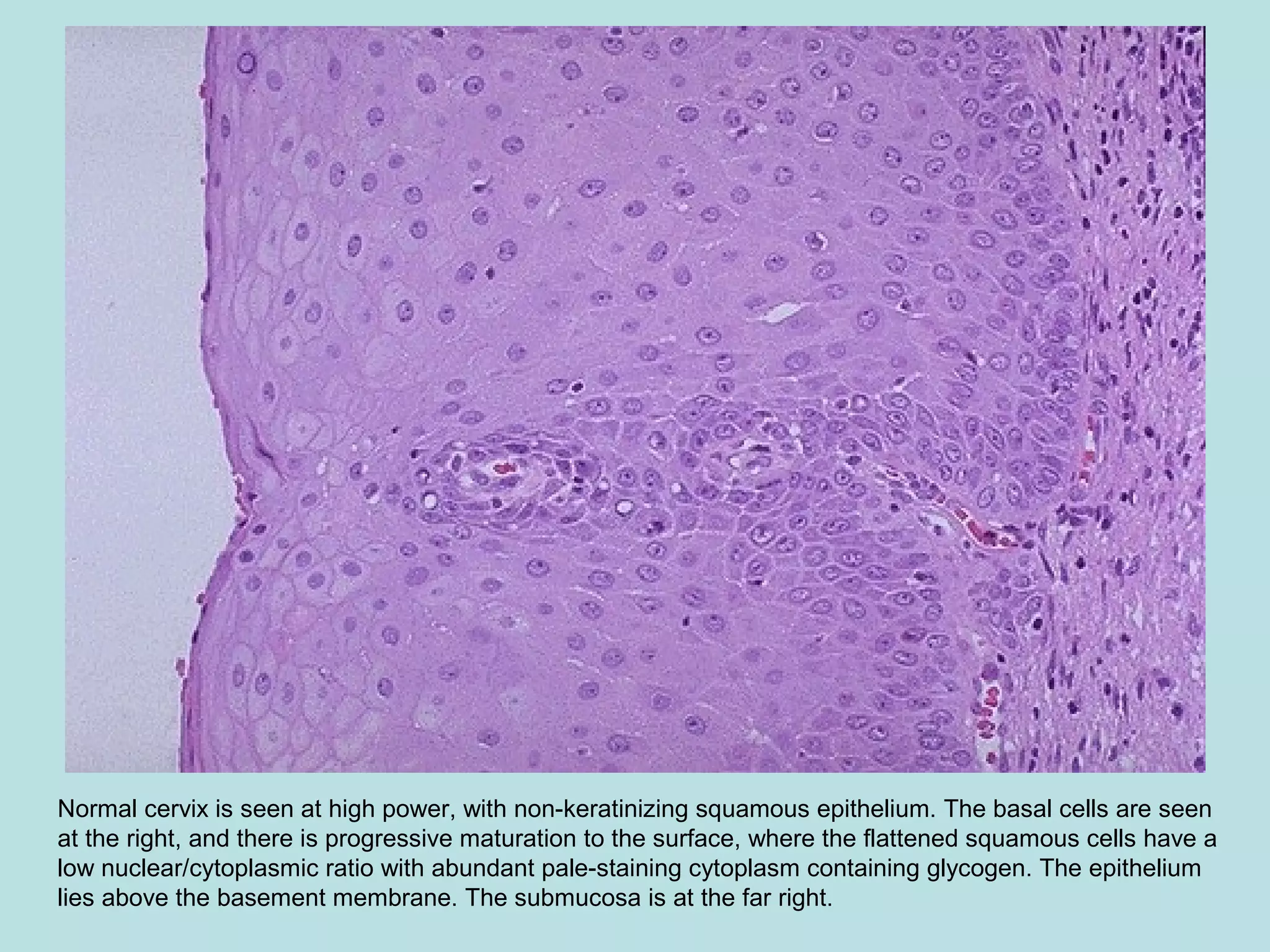 Pathology of cervix | PPT