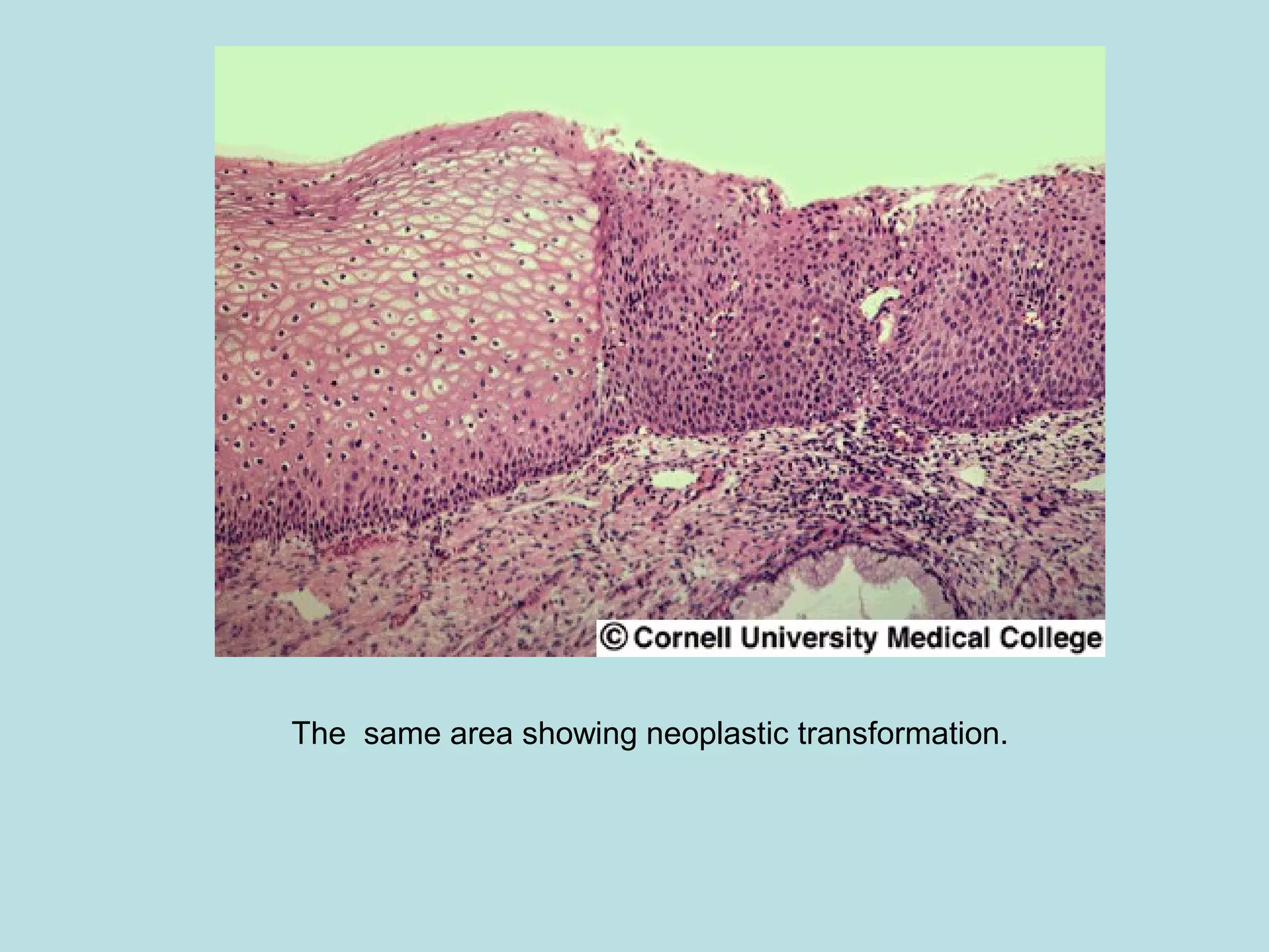 Pathology of cervix | PPT