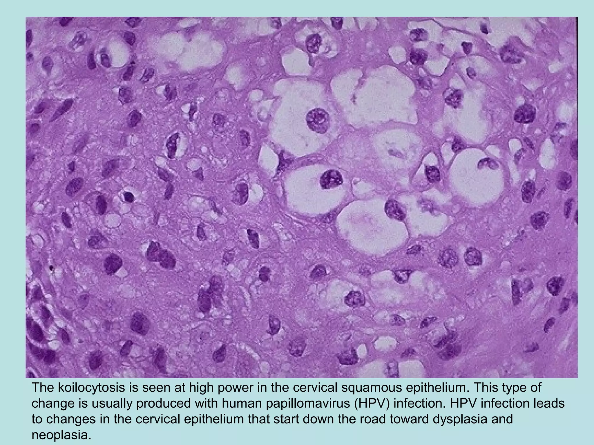 Pathology of cervix | PPT