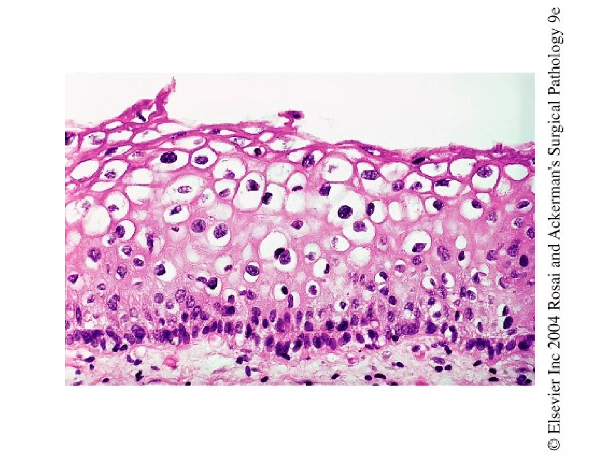 Pathology of cervix | PPT