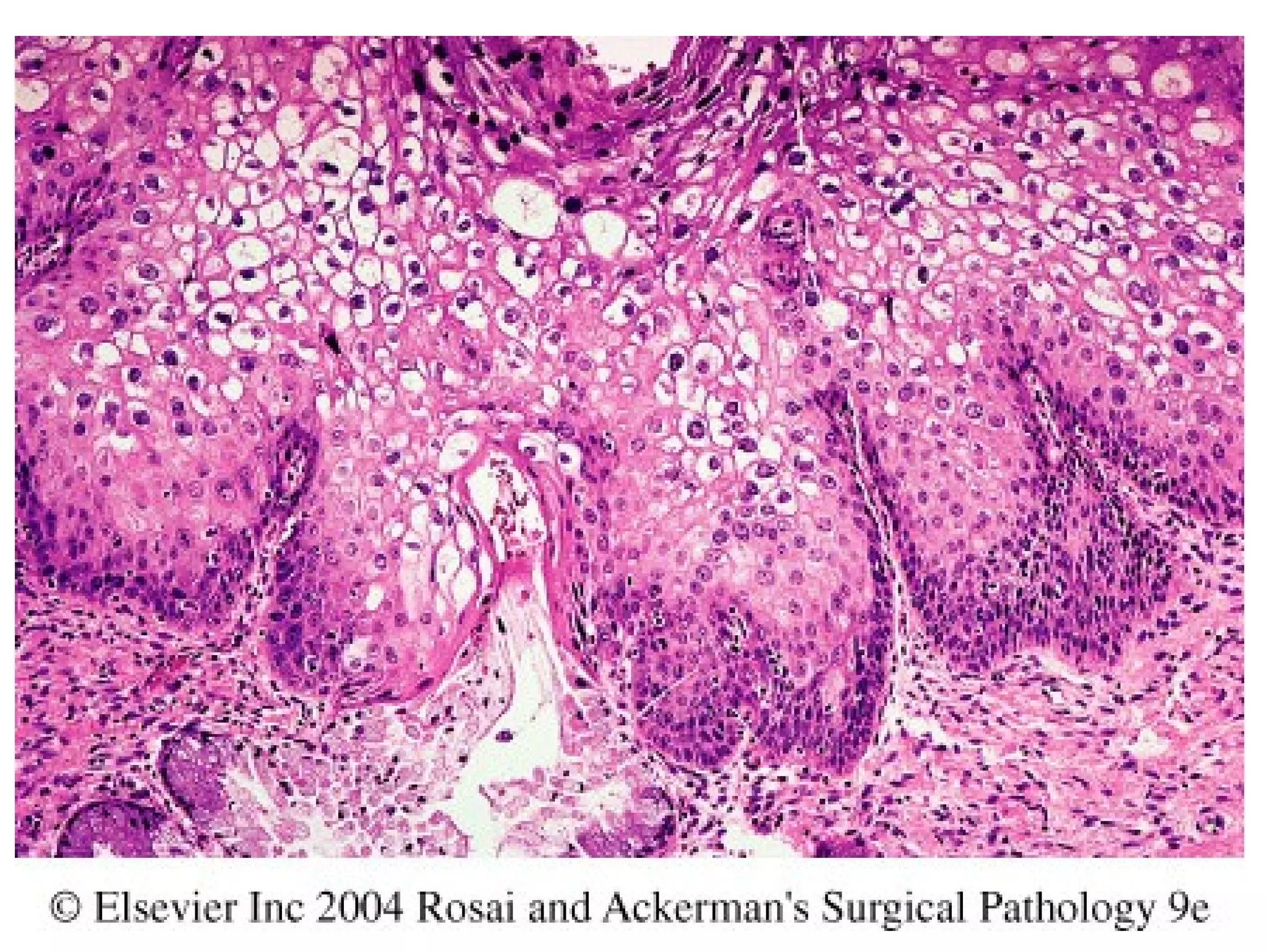 Pathology of cervix | PPT