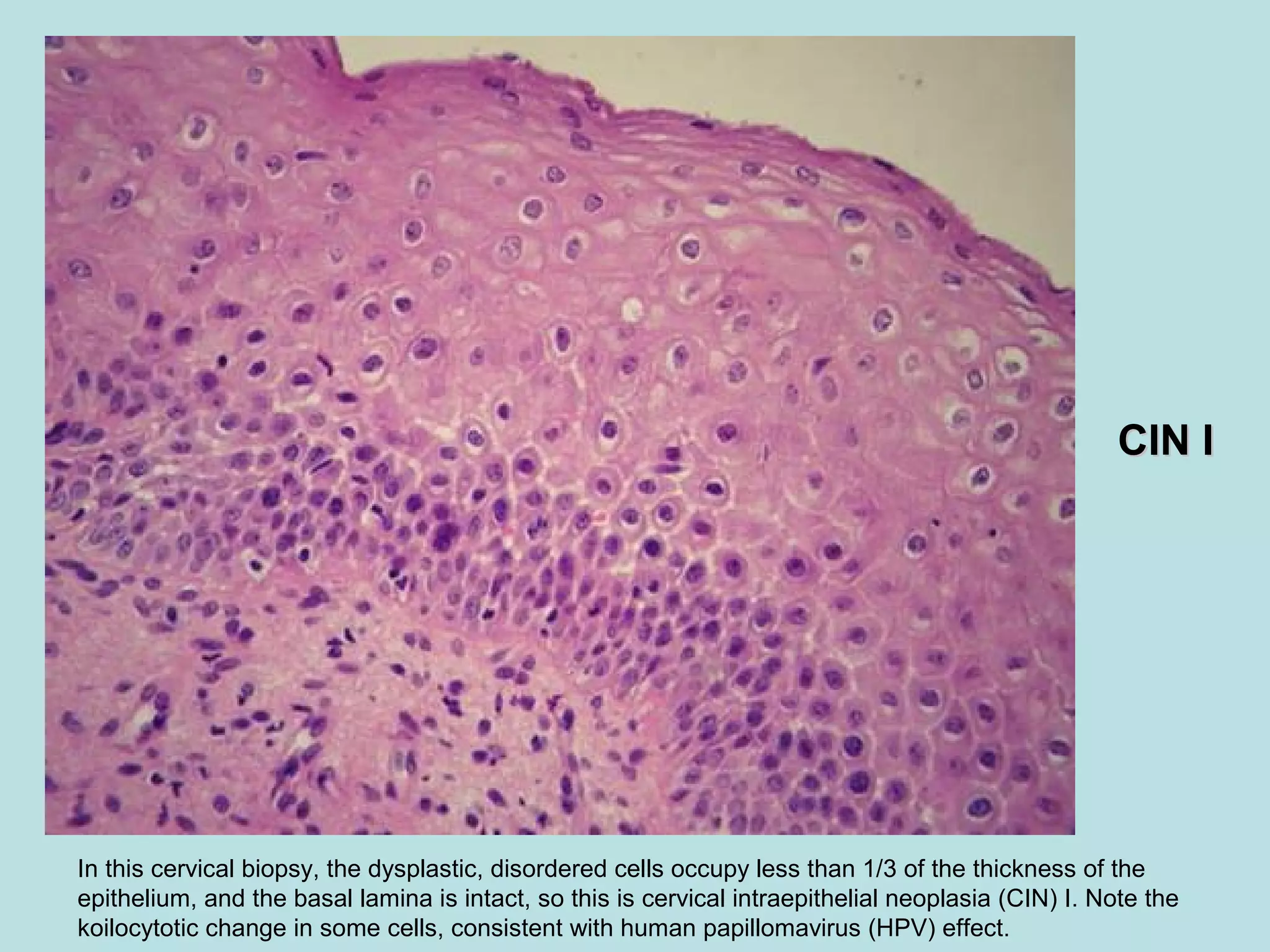 Pathology of cervix | PPT