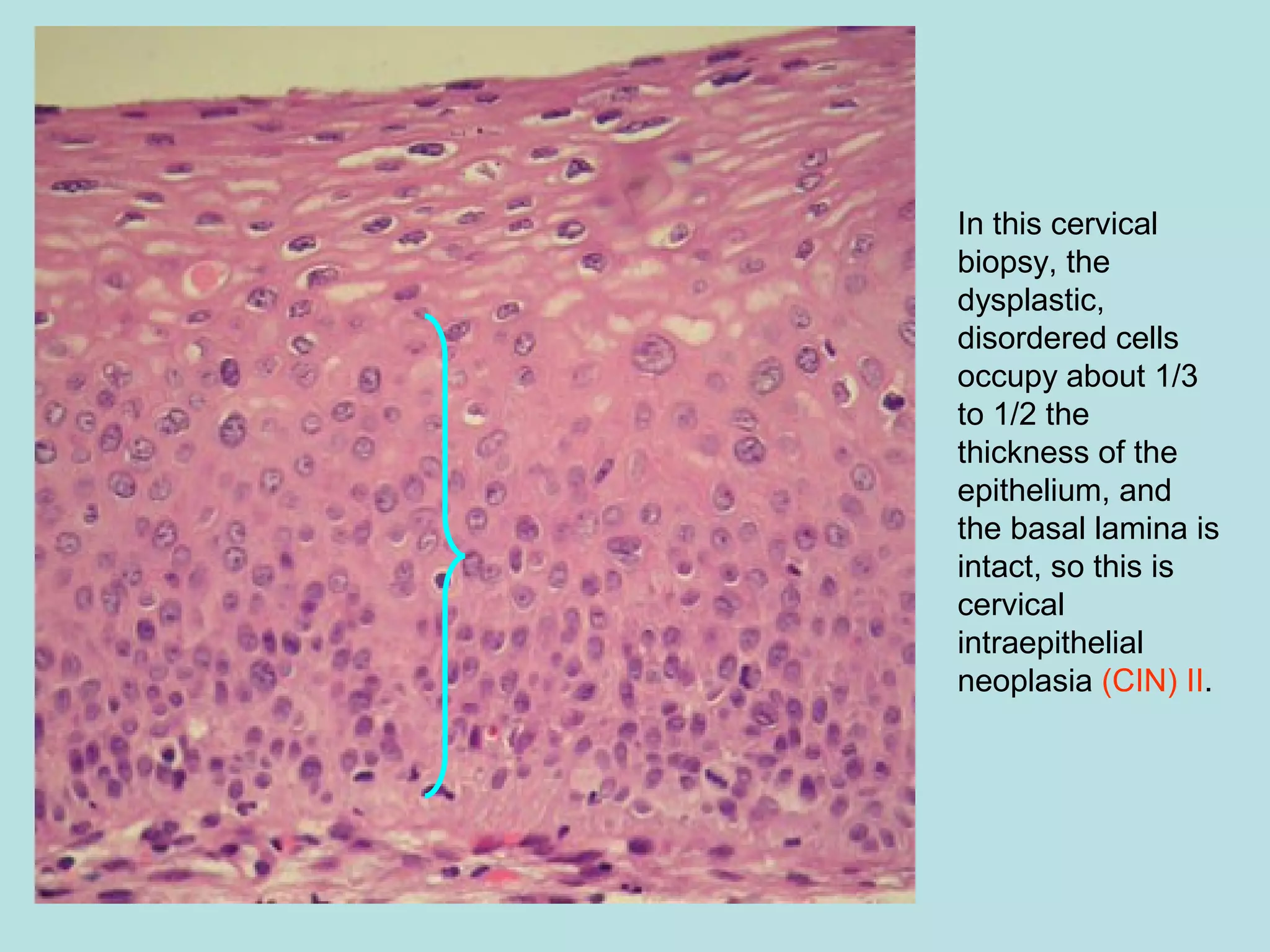 Pathology of cervix | PPT