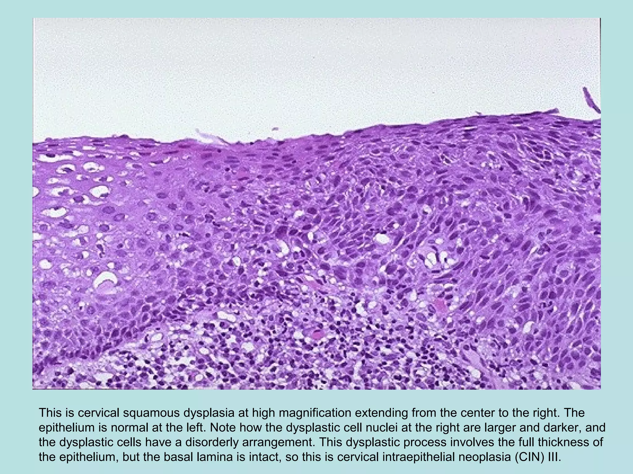 Pathology of cervix | PPT