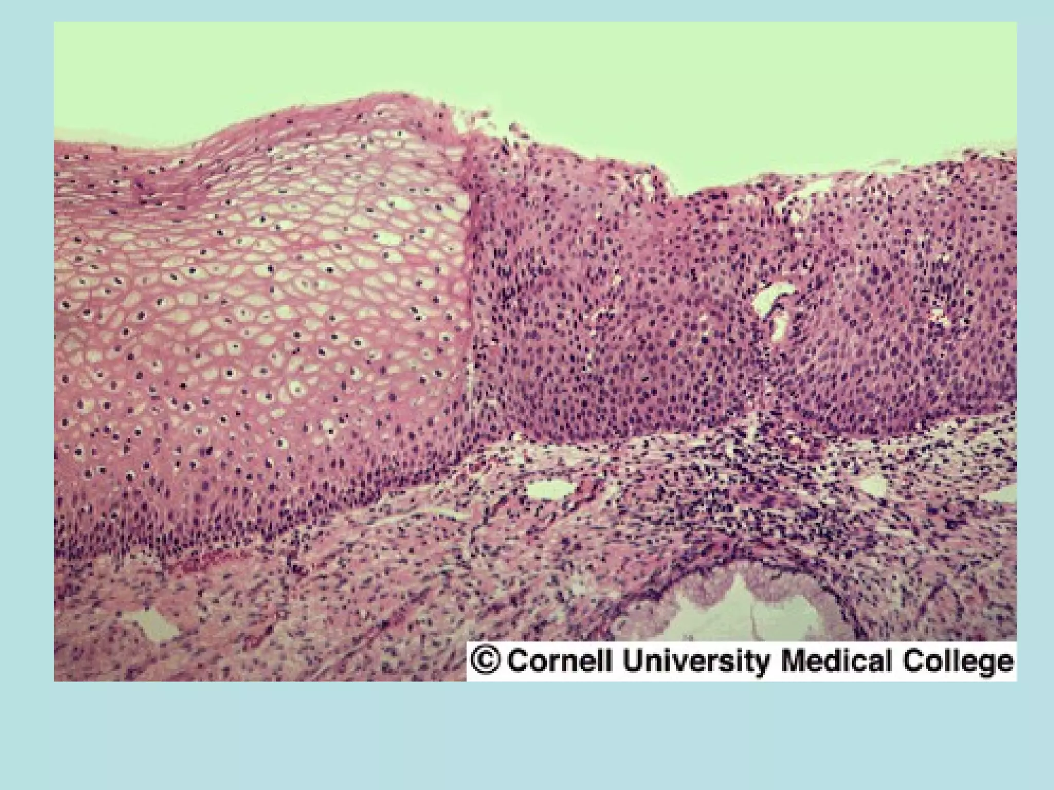 Pathology of cervix | PPT
