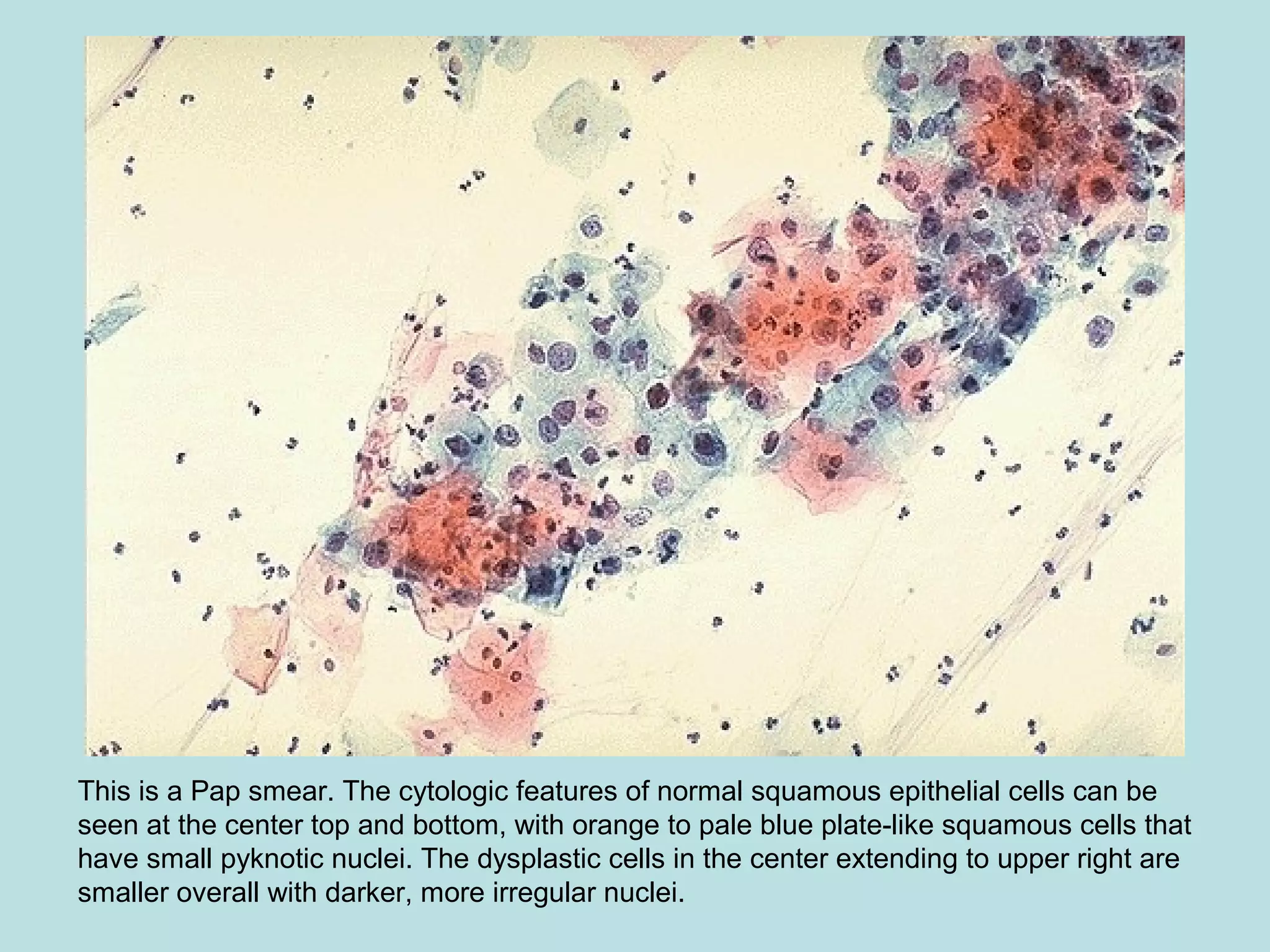 Pathology of cervix | PPT