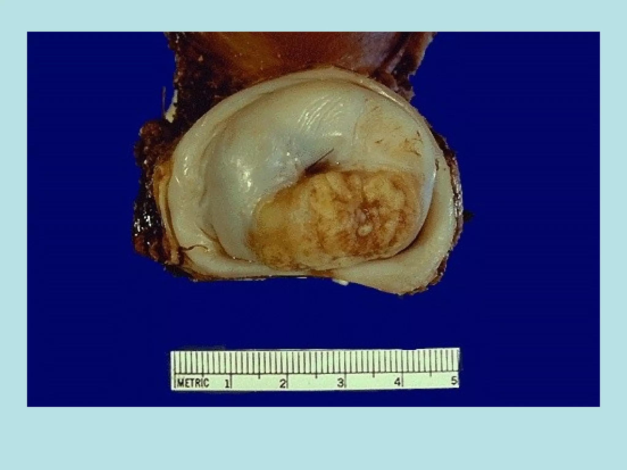 Pathology of cervix | PPT