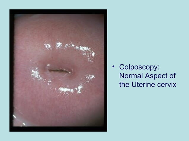 Pathology of cervix | PPT