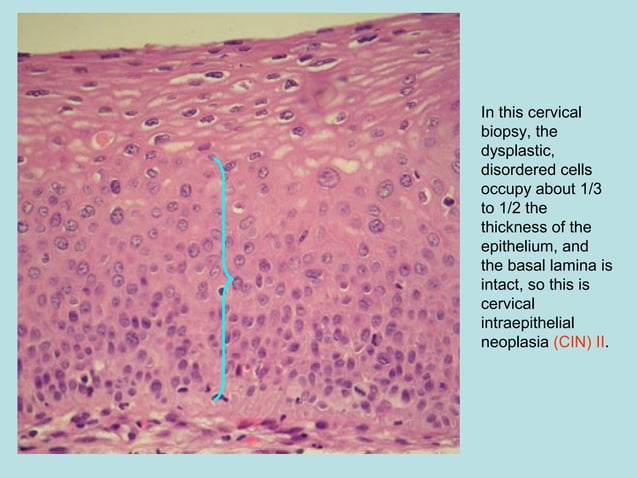 Pathology of cervix | PPT