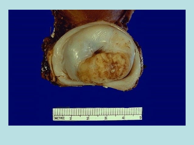 Pathology of cervix | PPT