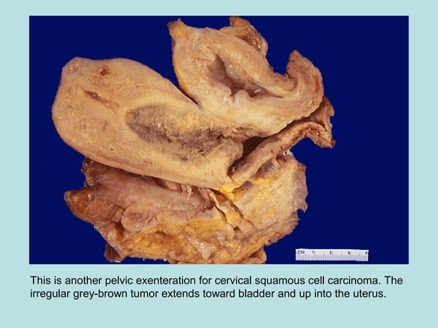 Pathology of cervix | PPT