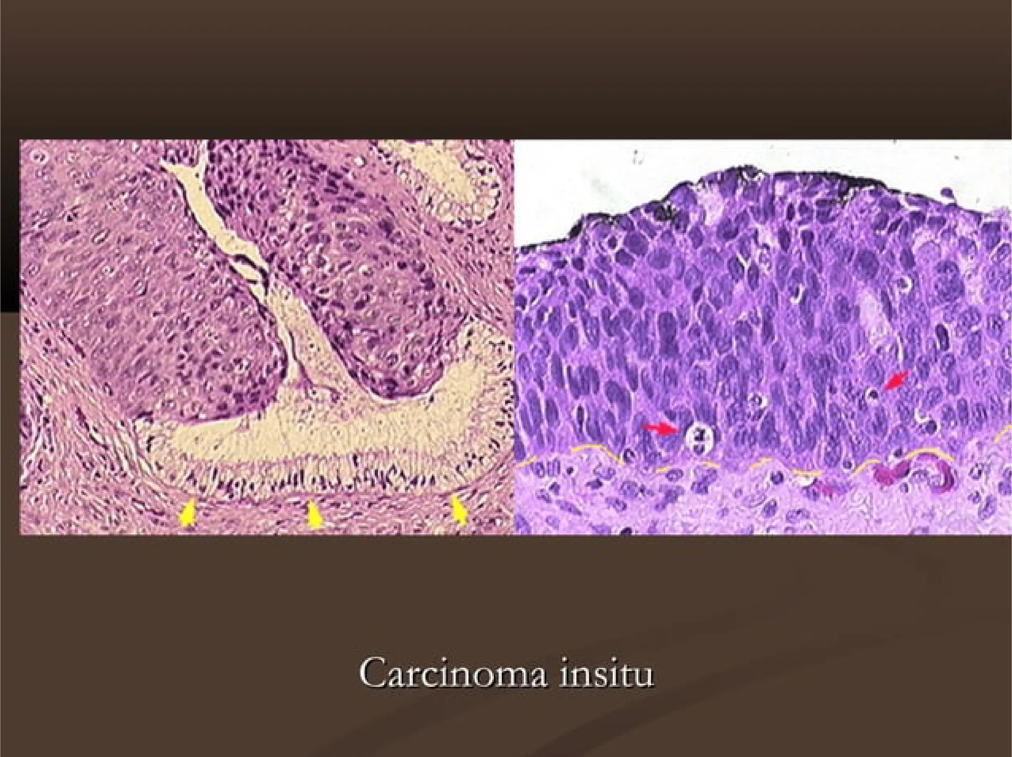 Pathological lesions of cervix.ppt benign and malignant lesions of ...