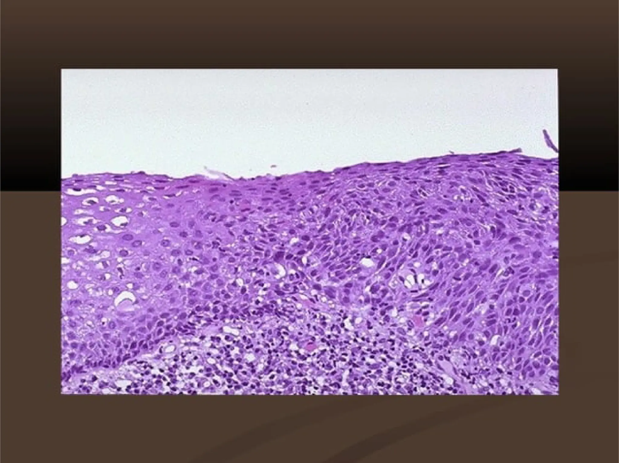 Pathological lesions of cervix.ppt benign and malignant lesions of ...