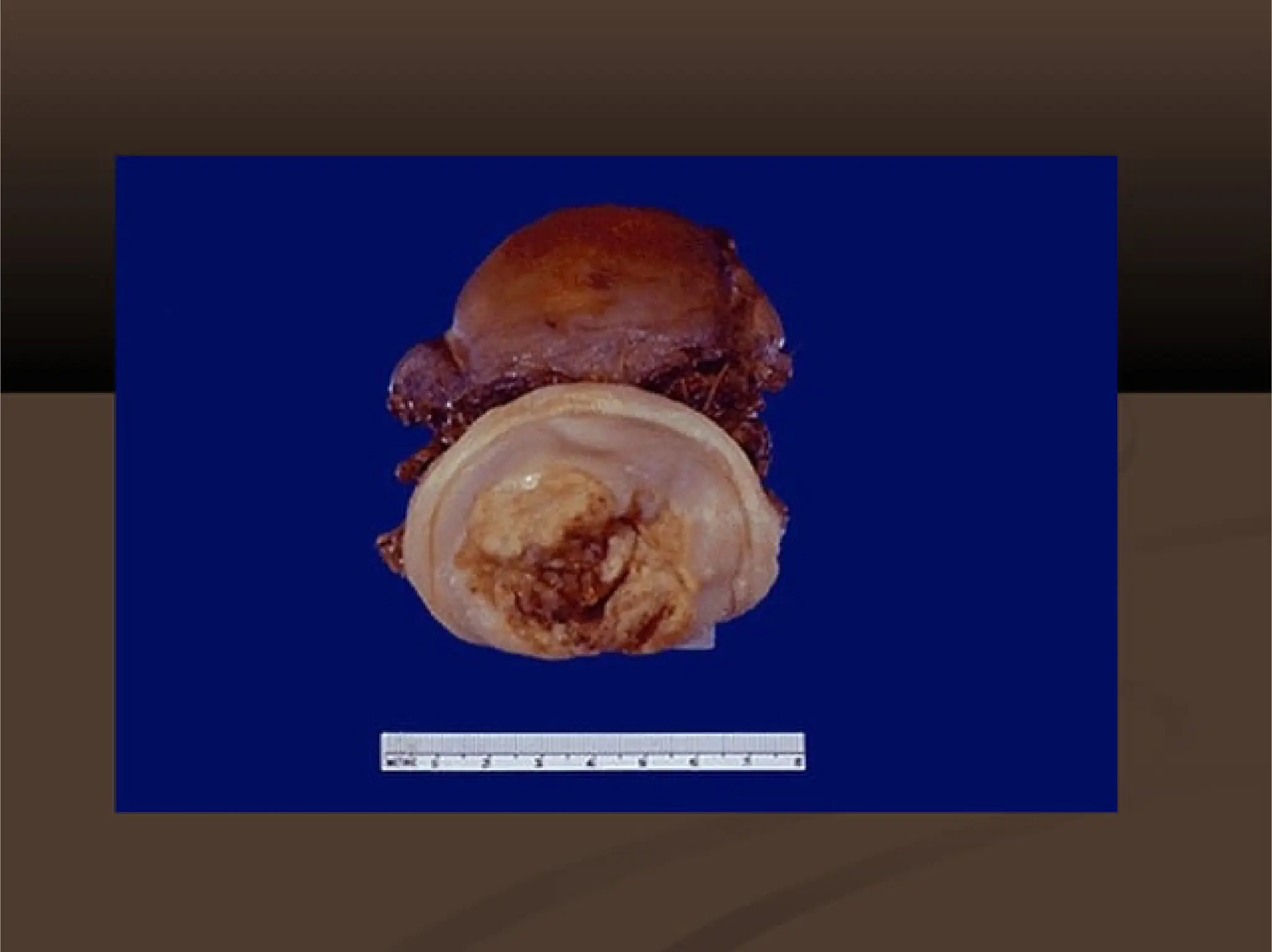 Pathological lesions of cervix.ppt benign and malignant lesions of ...