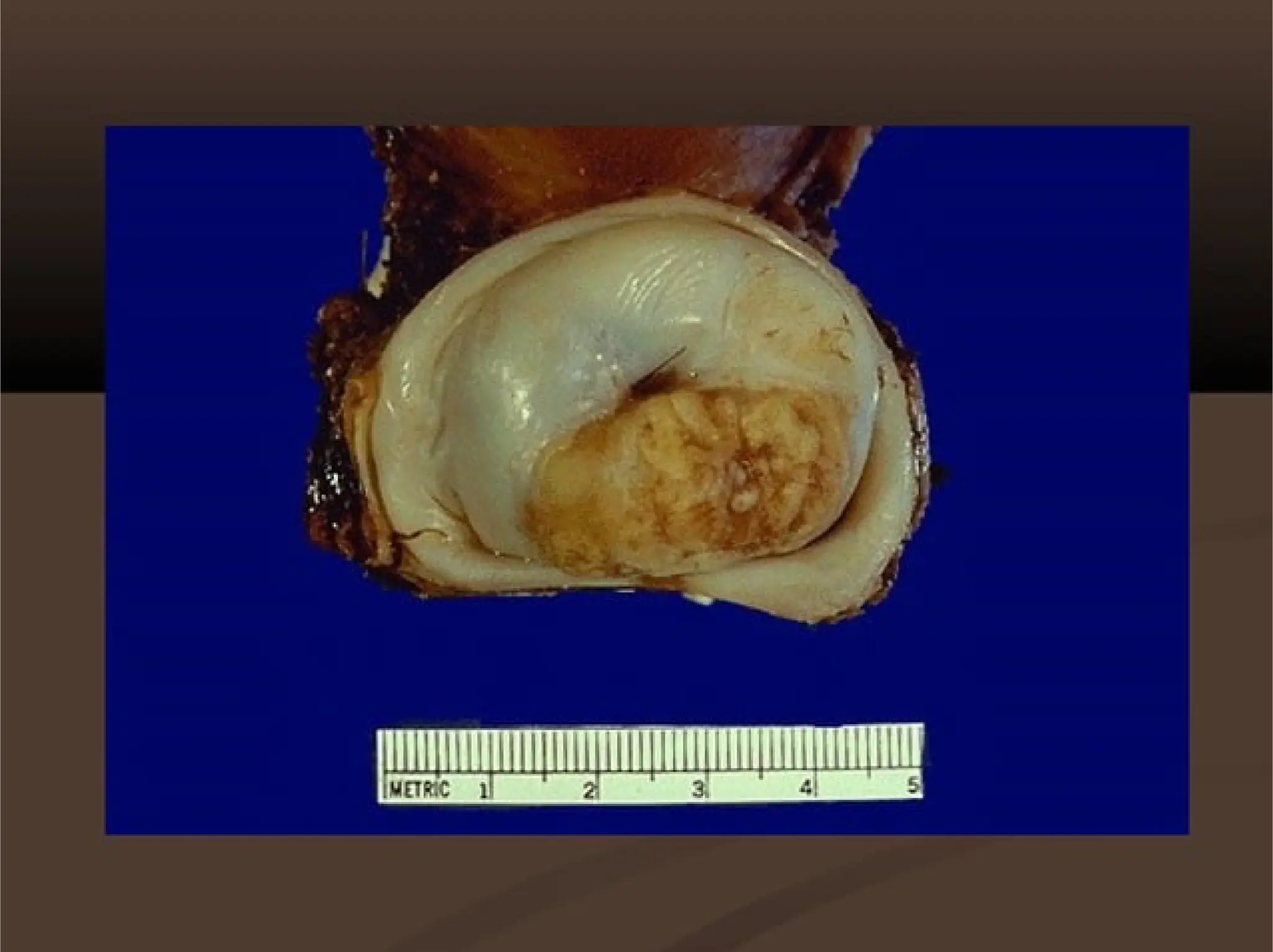 Pathological lesions of cervix.ppt benign and malignant lesions of ...