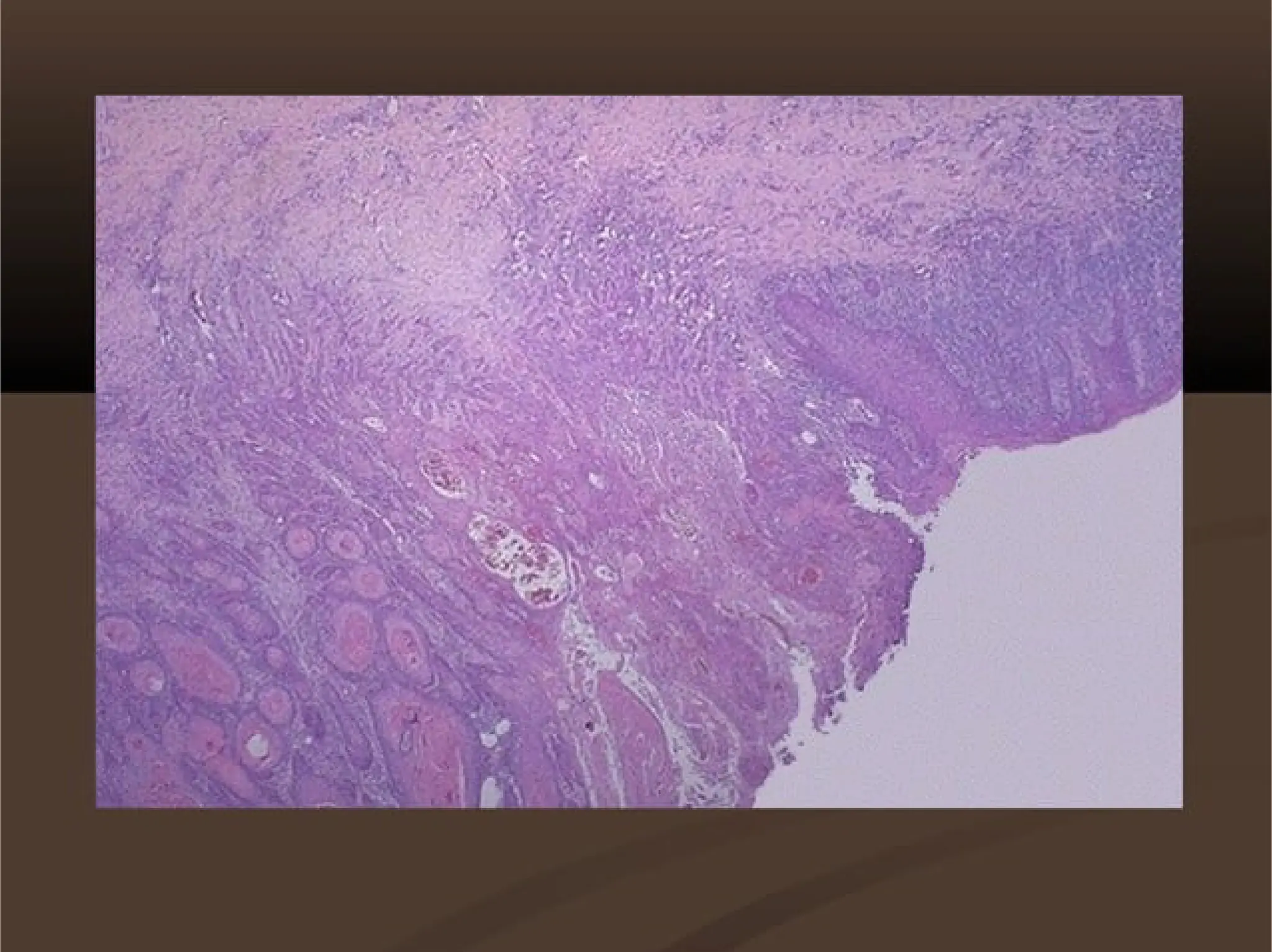Pathological lesions of cervix.ppt benign and malignant lesions of ...