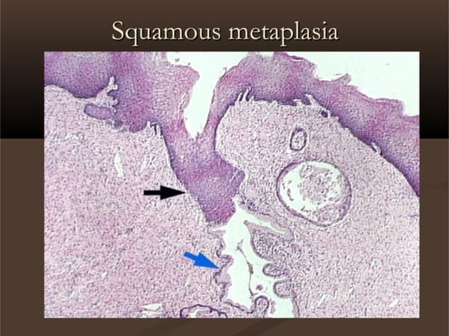 Pathological lesions of cervix.ppt benign and malignant lesions of ...