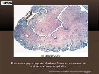 Pathological lesions of cervix.ppt benign and malignant lesions of ...