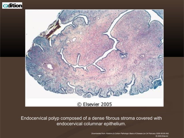 Pathological lesions of cervix.ppt benign and malignant lesions of ...