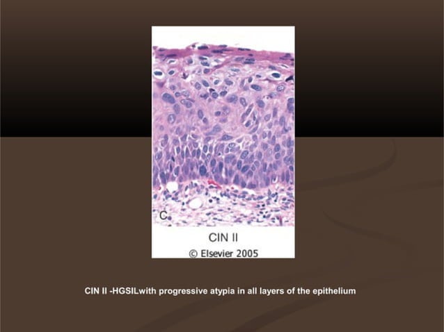 Pathological lesions of cervix.ppt benign and malignant lesions of ...