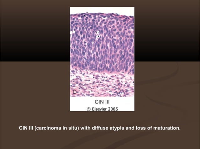Pathological lesions of cervix.ppt benign and malignant lesions of ...