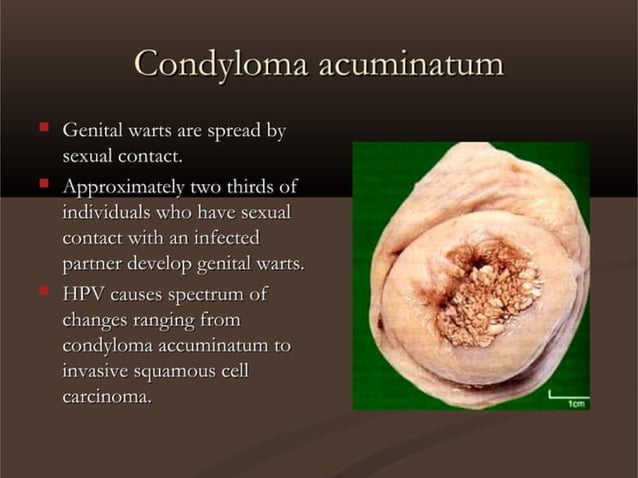 Pathological lesions of cervix.ppt benign and malignant lesions of ...