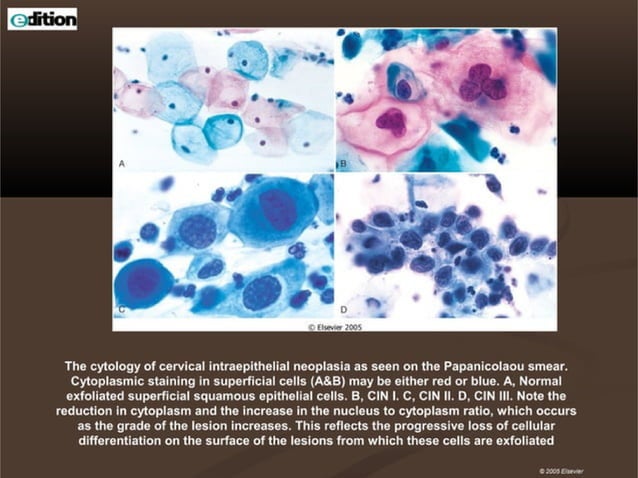 Pathological lesions of cervix.ppt benign and malignant lesions of ...