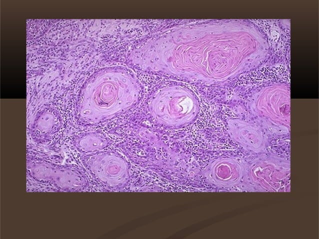 Pathological lesions of cervix.ppt benign and malignant lesions of ...