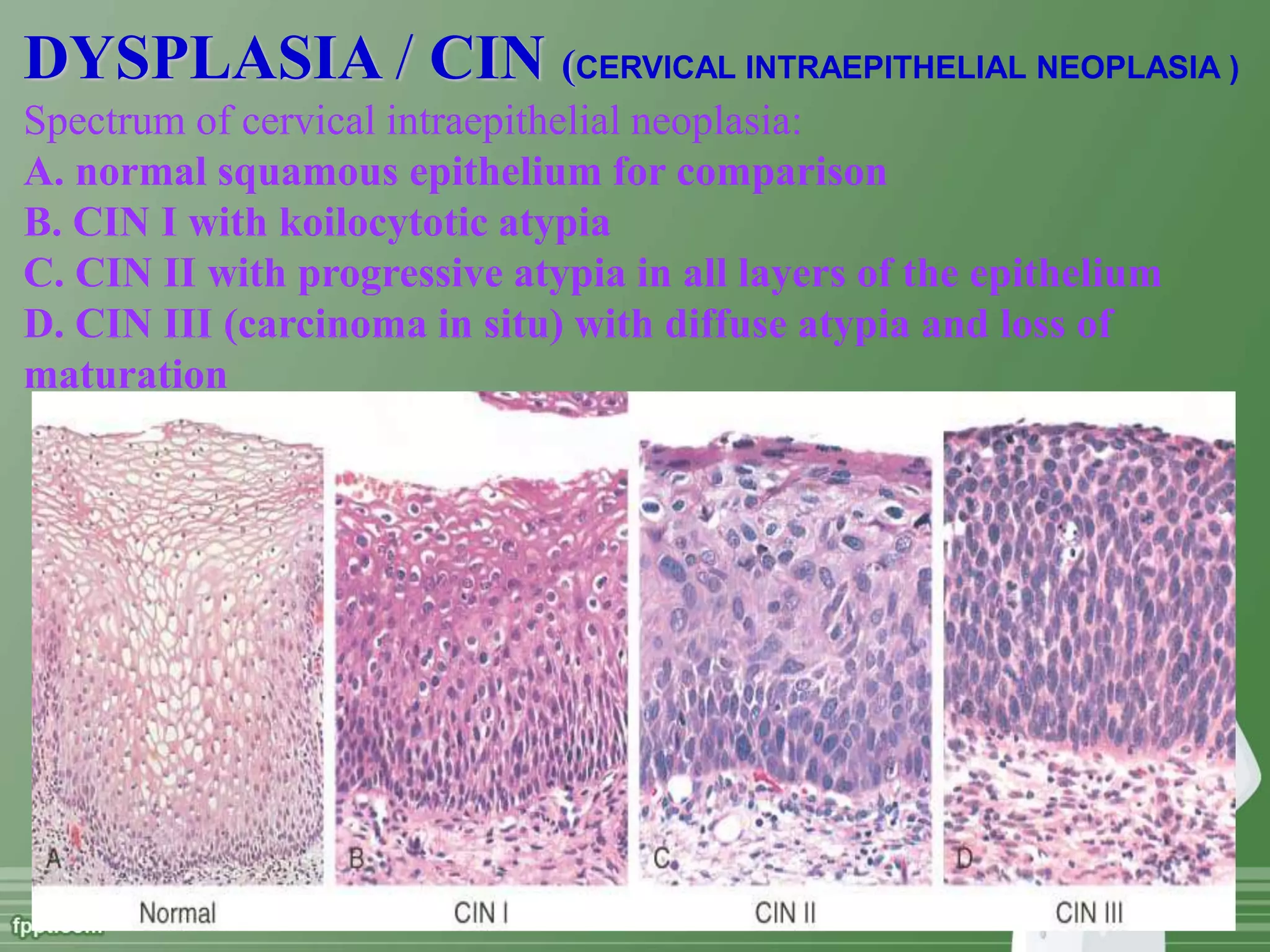Pathology Of Cervix Anduterus Ppt