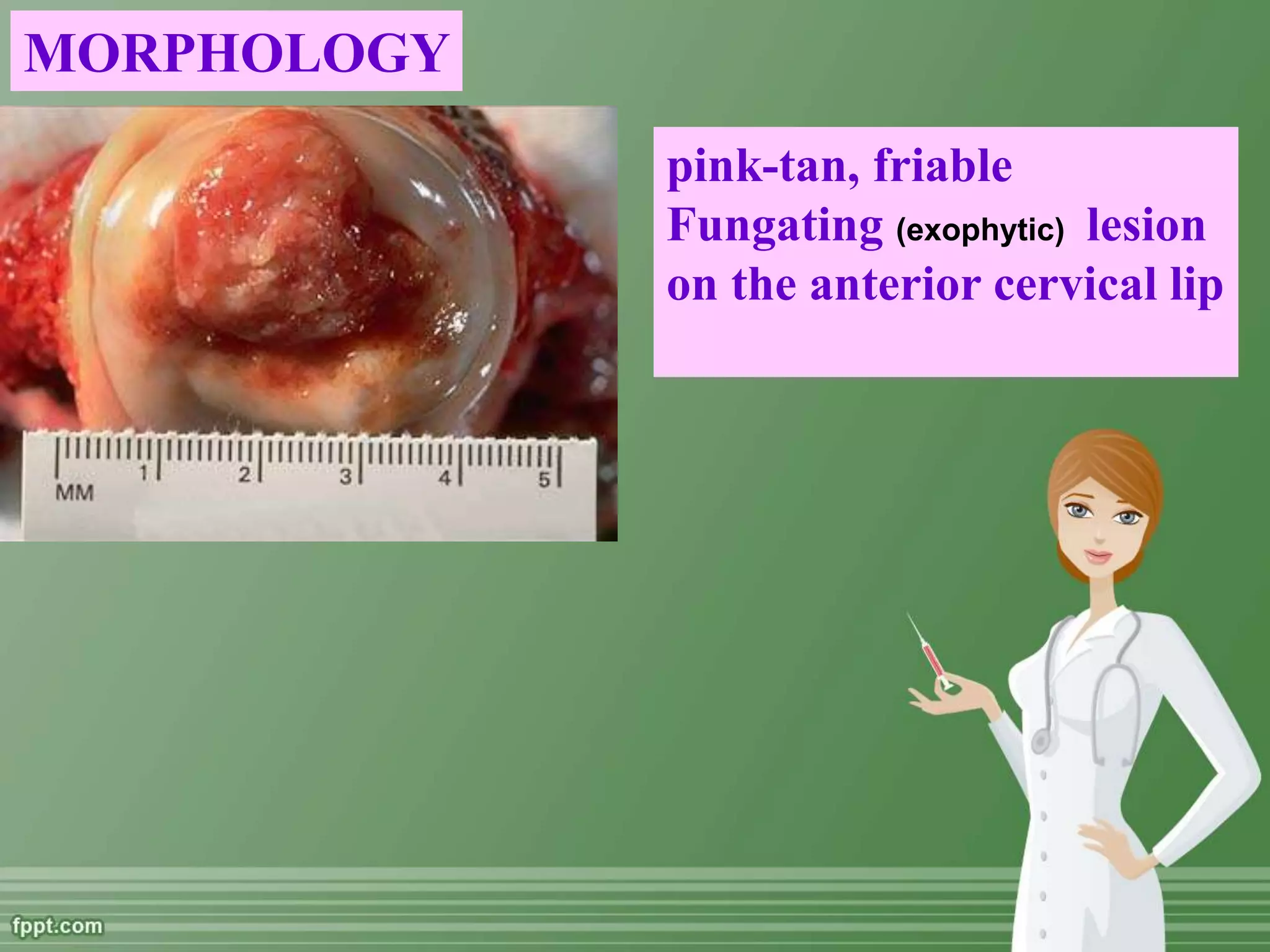 Pathology Of Cervix Anduterus Ppt
