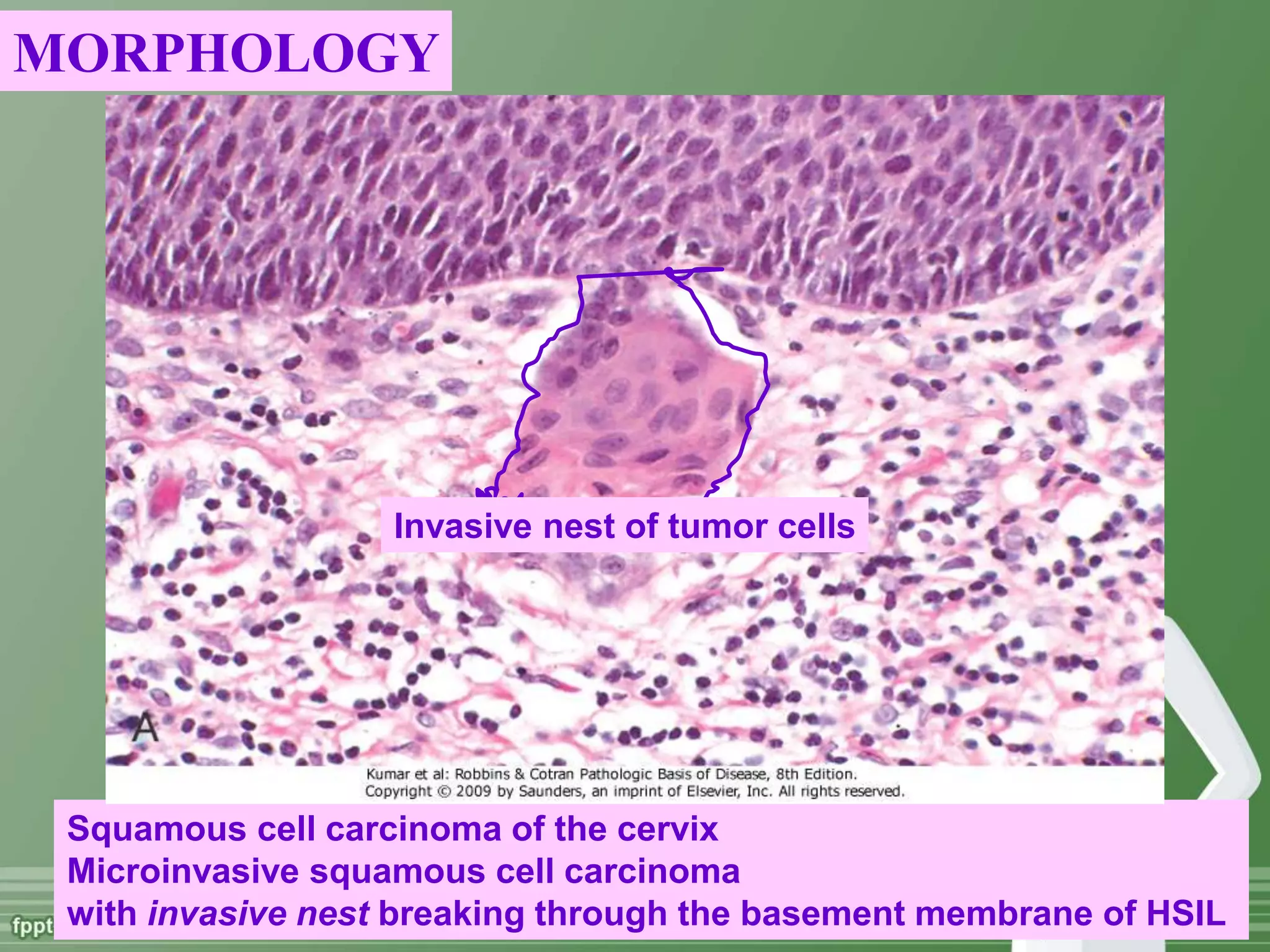 Pathology of cervix &uterus | PPTX