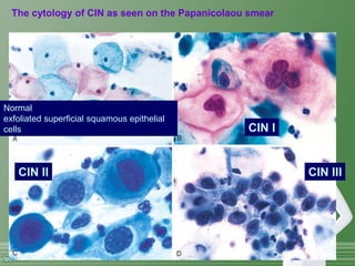 Pathology of cervix &uterus | PPTX