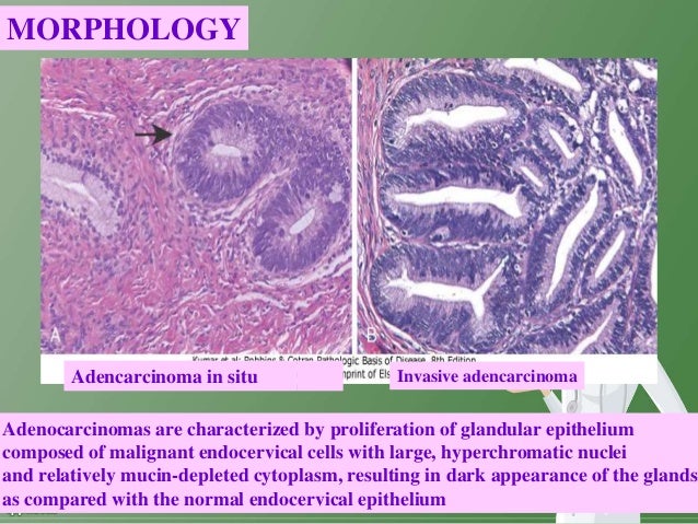 Pathology of cervix &uterus