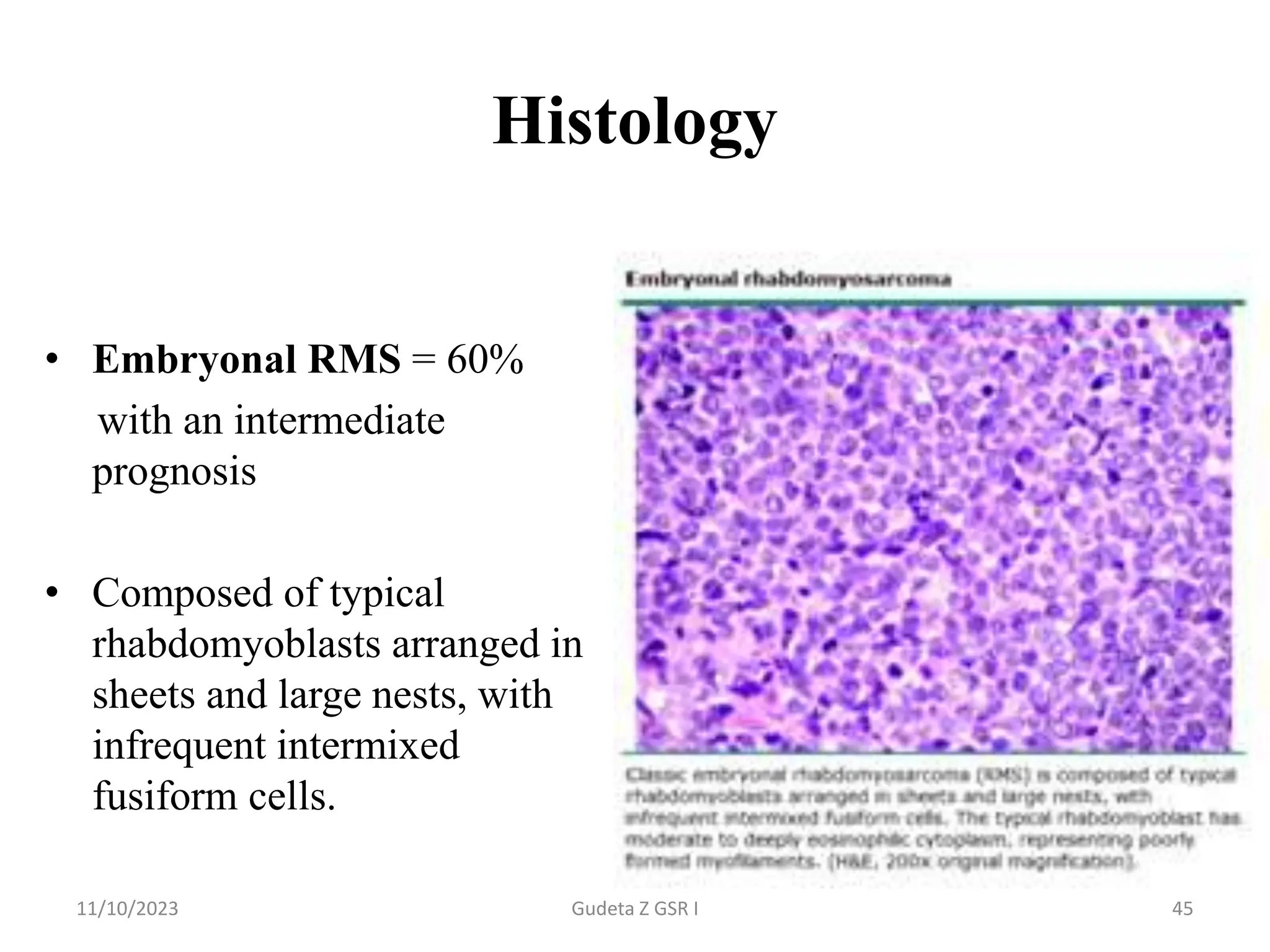 Pathology of Common Childhood Abdominal Tumor Dr Gudeta.pptx