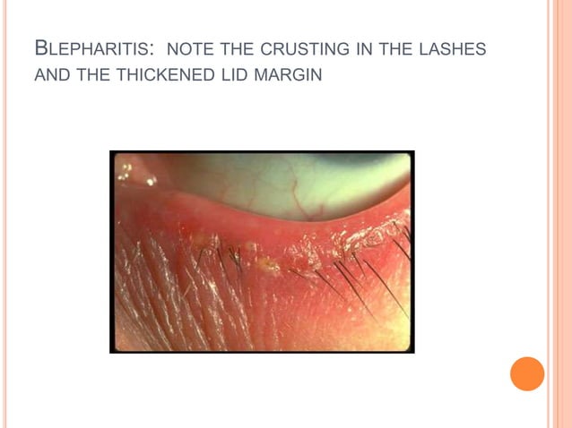 Pathology of eye lids and adnexa | PPTX | Ear, Nose and Throat Conditions | Diseases and Conditions