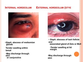 Pathology of eye lids and adnexa | PPTX