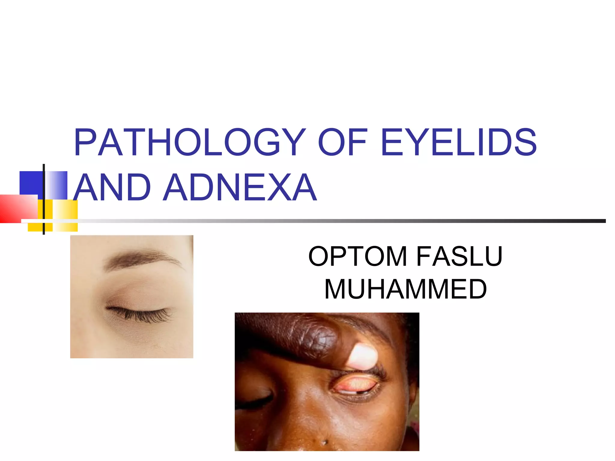 Pathology of eyelids and adnexa | PPT