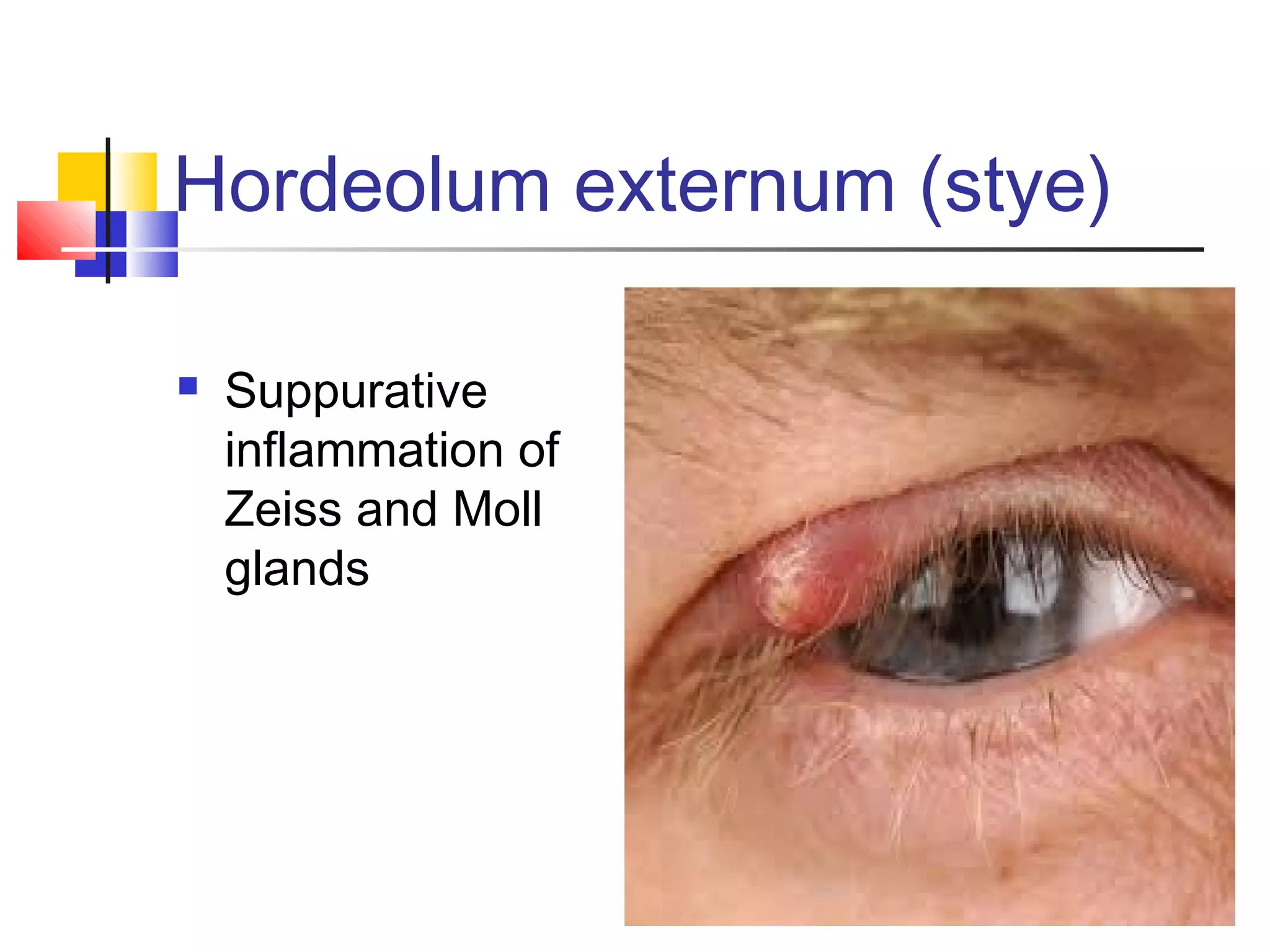 Pathology of eyelids and adnexa | PPT