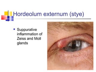 Pathology of eyelids and adnexa | PPT