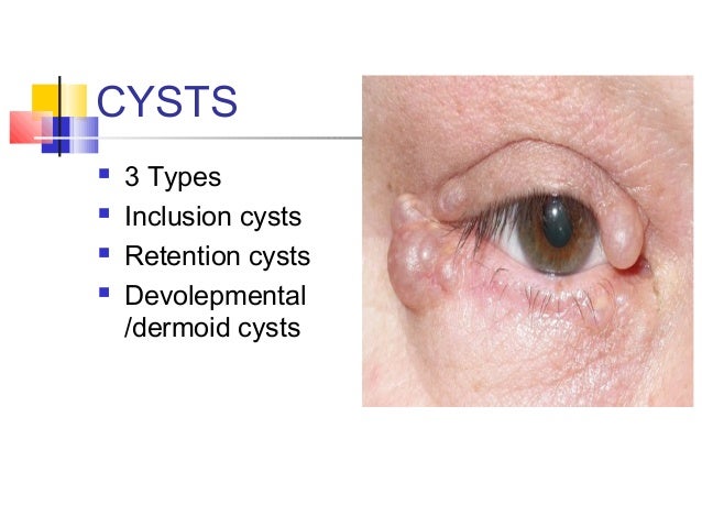 Eyelid Cysts Bopss