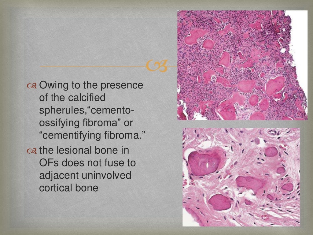 Pathology of fibro osseous lesions