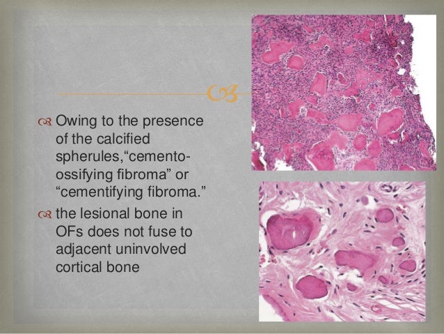 Cementifying Fibroma